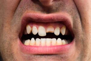 Broken Tooth But No Pain? Here’s What to Do.